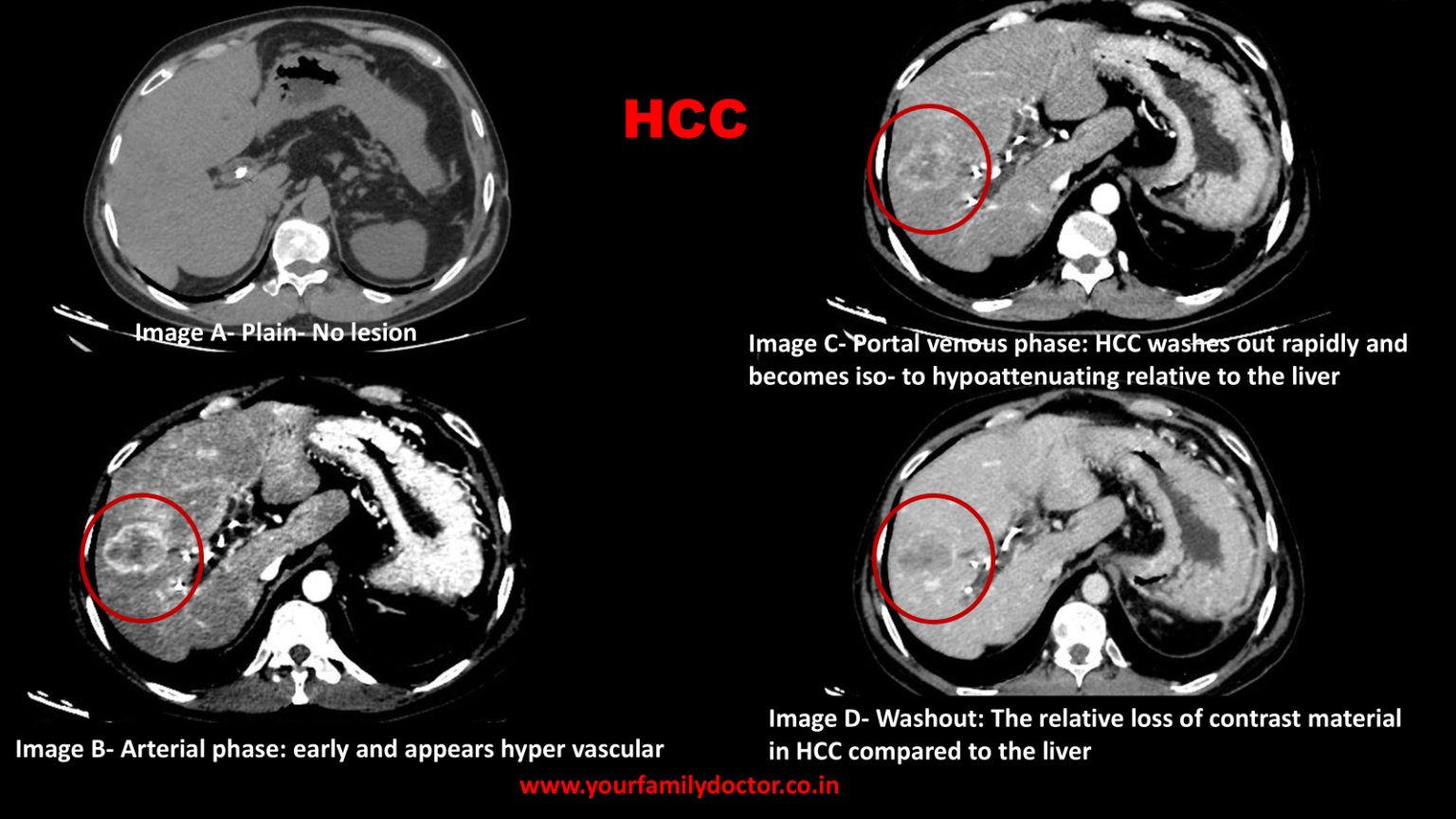 Hepatocellular Carcinoma (HCC)-Radiological Findings and Management ...